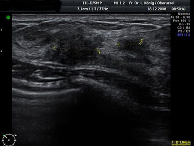 MAMMASONOGRAPHIE – Ultraschalluntersuchung der Brust – Dr. med. Lilian ...